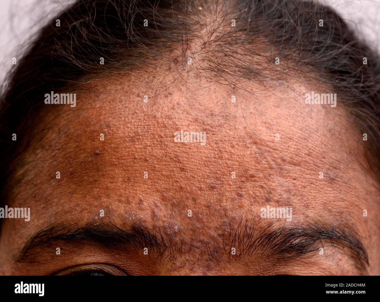 Not for use in Television Not for use in Television Darier's disease. Papules on the forehead of ...