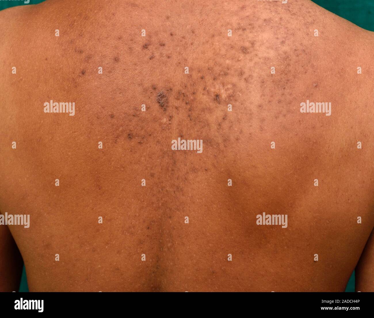 Not for use in Television Not for use in Television Darier's disease ...