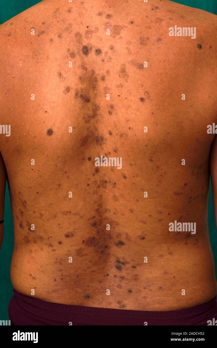 Not for use in Television Not for use in Television Pemphigus foliaceus ...