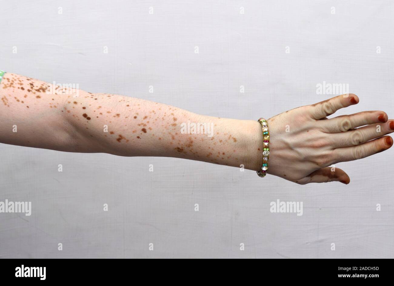 Not for use in Television Not for use in Television Vitiligo skin ...