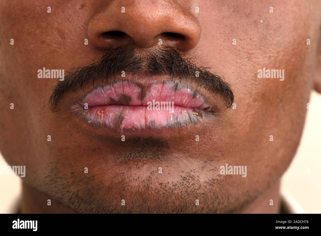 Not for use in Television Not for use in Television Discoid lupus ...