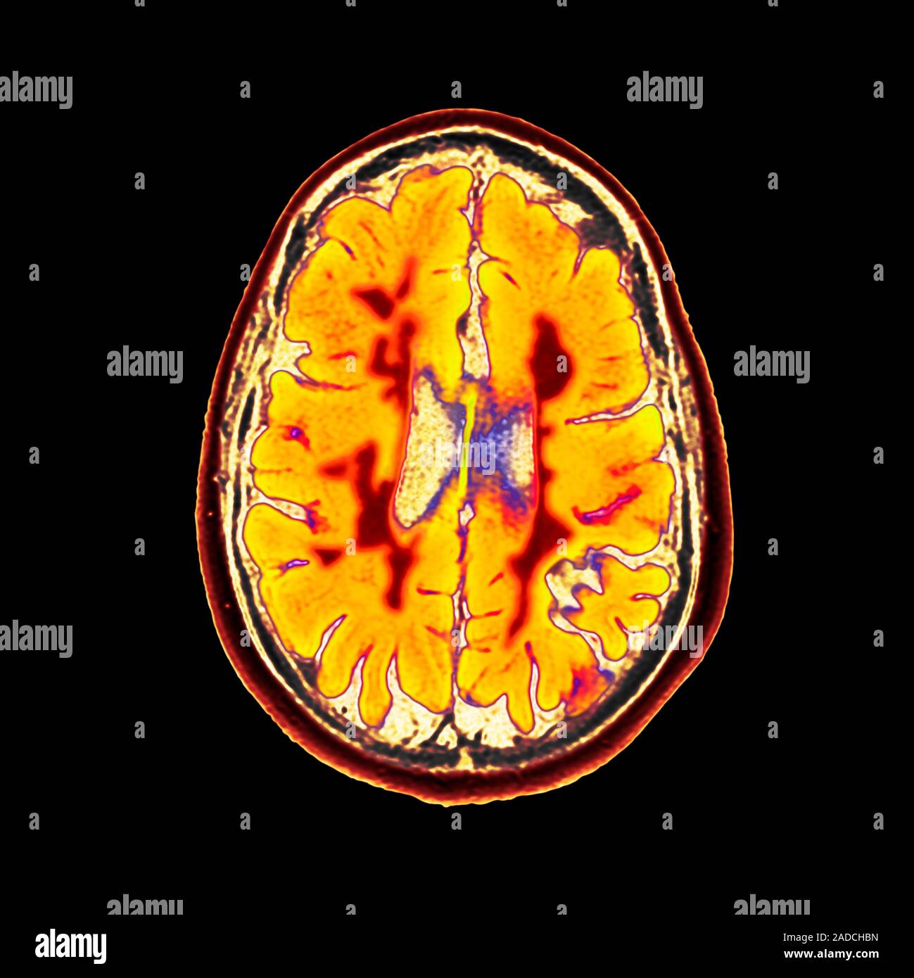 Multiple sclerosis. Coloured axial magnetic resonance imaging (MRI) scan through the brain of a ...