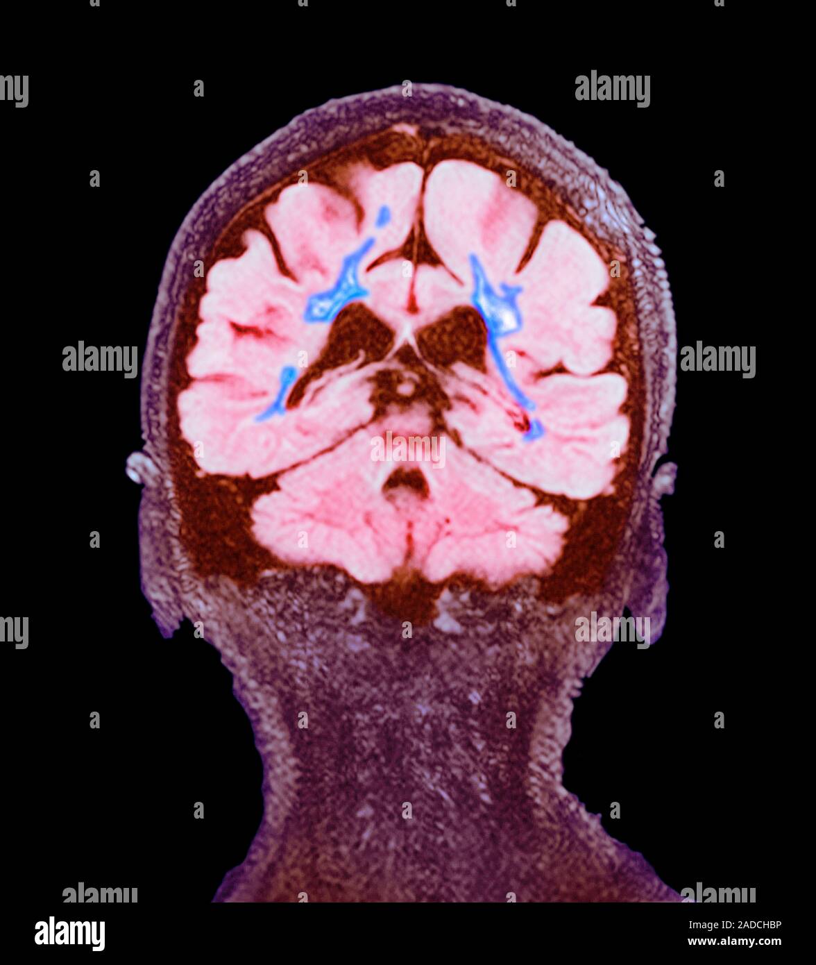 Multiple sclerosis. Coloured coronal magnetic resonance imaging (MRI) scan through the brain of ...