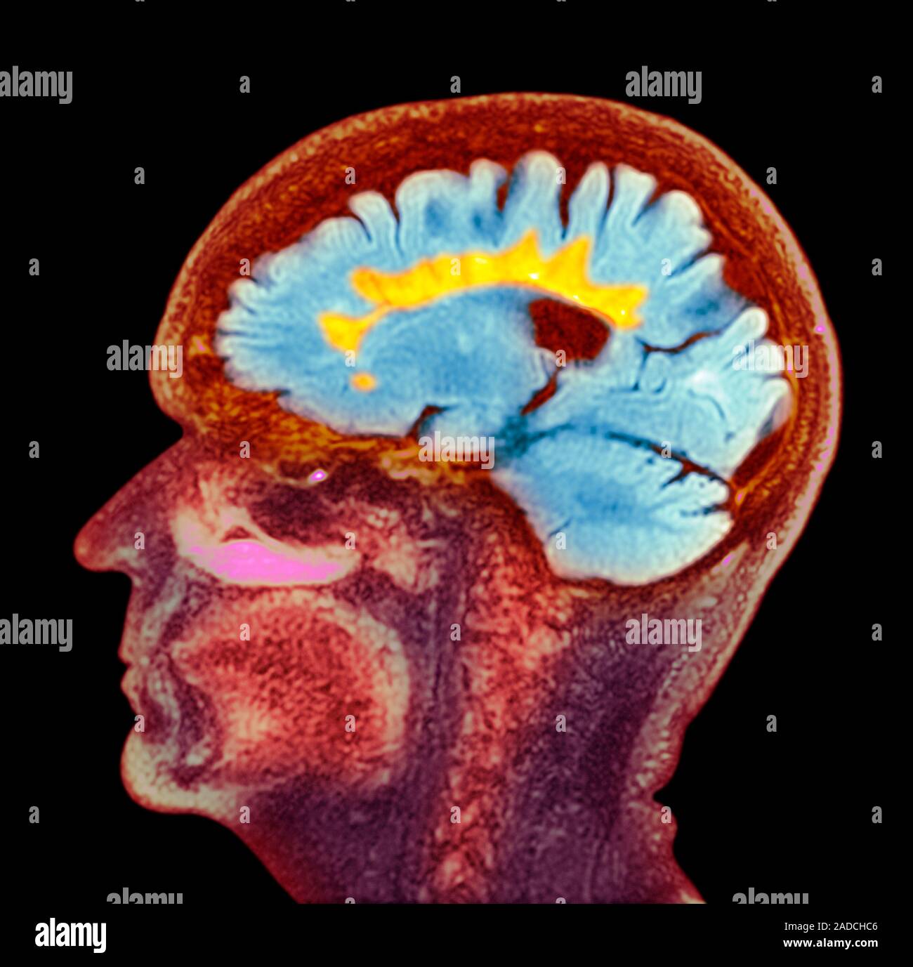 Multiple sclerosis. Coloured sagittal magnetic resonance imaging (MRI) scan through the brain of ...
