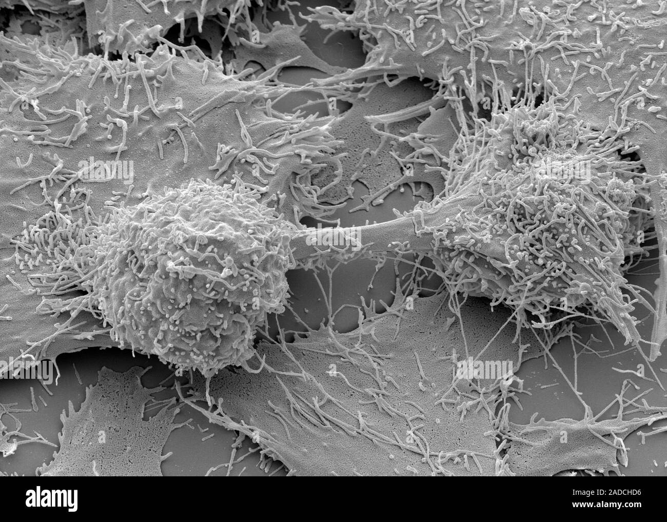 Dividing liver cancer cell. Scanning electron micrograph (SEM) of a ...