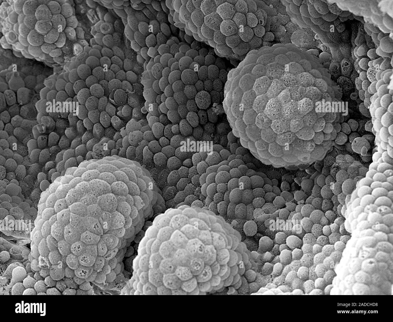 Prostate Cancer Freeze Fracture Scanning Electron Micrograph Sem Of