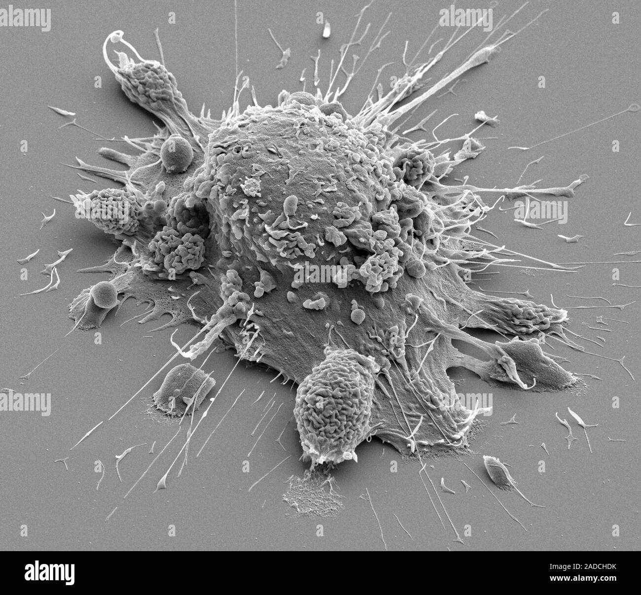 Mouth cancer cell. Scanning electron micrograph (SEM) of a squamous ...