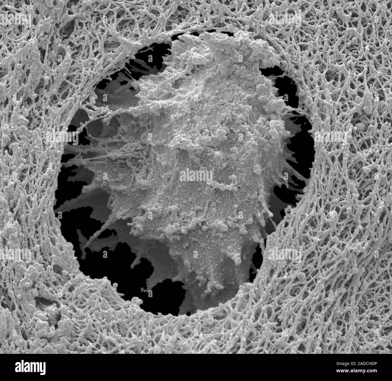 Bone cancer cell. Scanning electron micrograph of an osteosarcoma ...