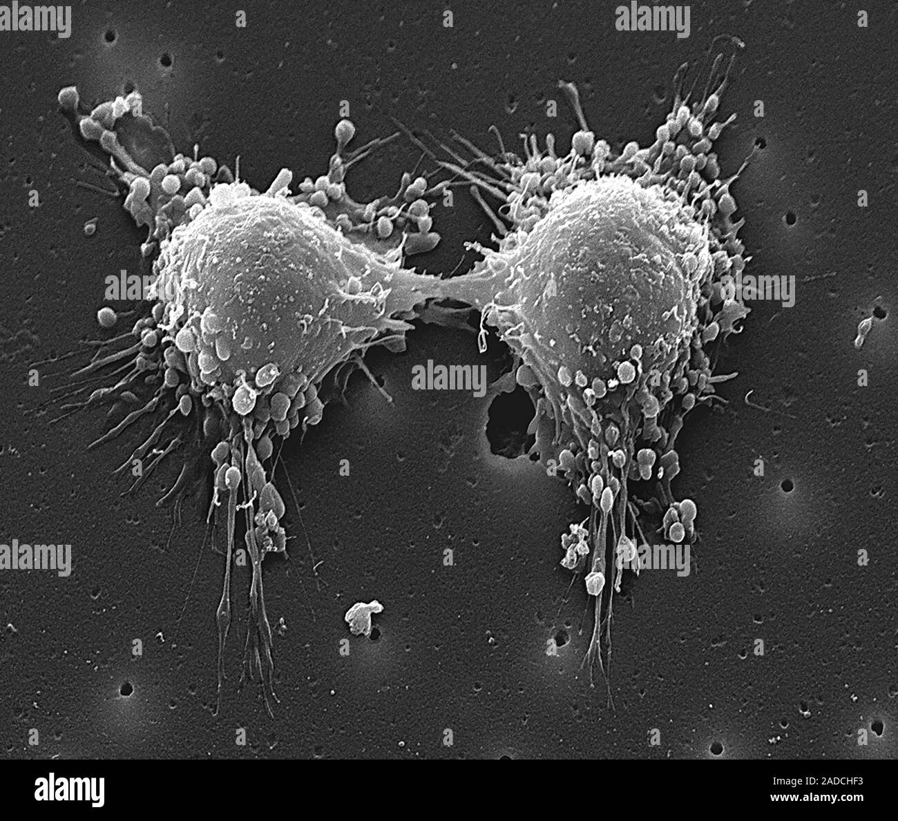Cancer cell division. Scanning electron micrograph (SEM) of two ...