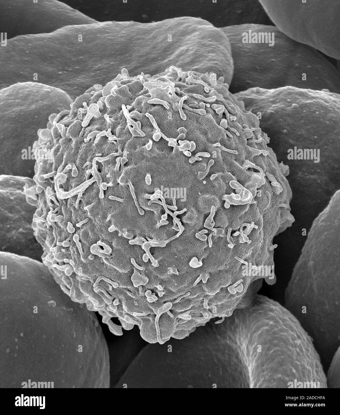 Leukaemia cell. Scanning electron micrograph (SEM) of a leukaemic ...