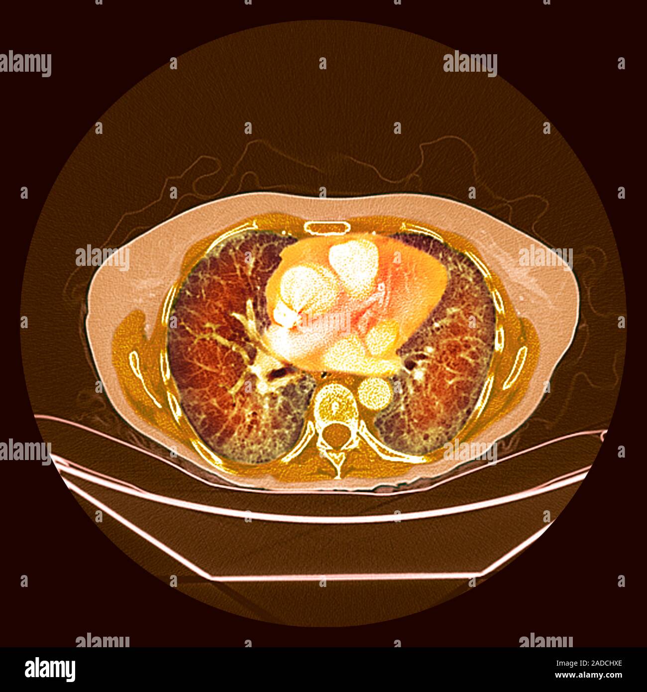 Pulmonary fibrosis. Coloured axial computed tomography (CT) scan of the ...