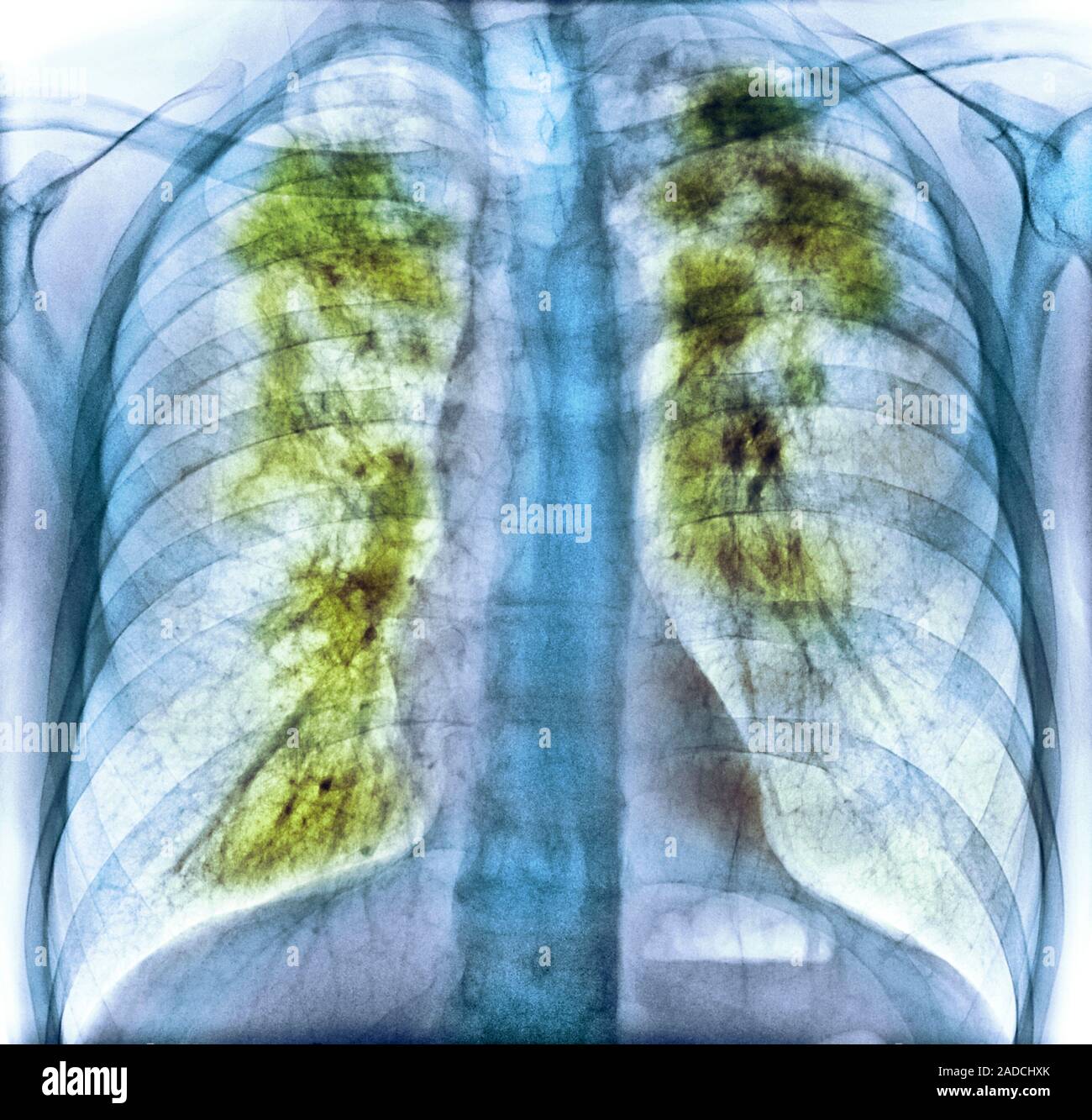 Sarcoidosis. Frontal coloured chest X-ray of the lungs of a 52-year-old ...