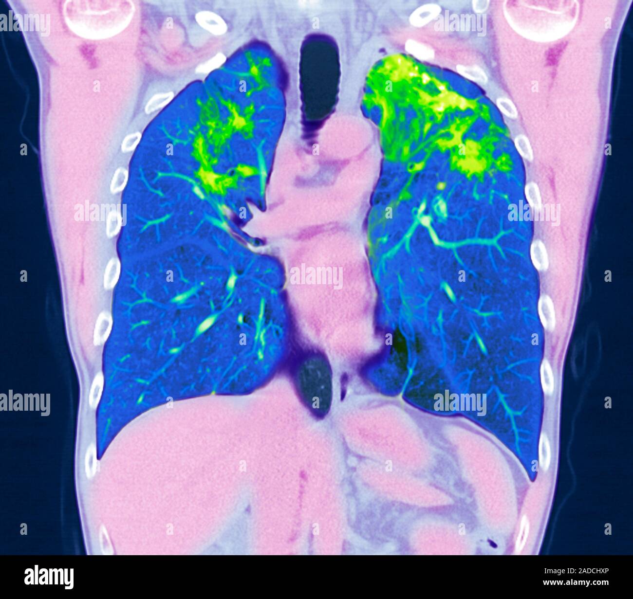 Pulmonary sarcoidosis. Computed tomography (CT) scan of a coronal ...