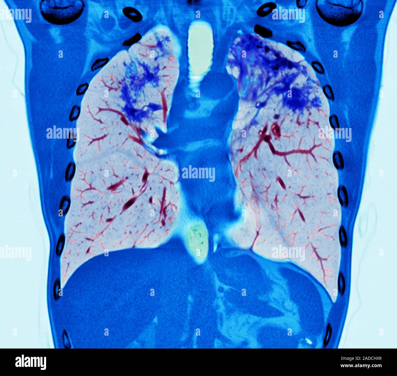 Pulmonary sarcoidosis. Computed tomography (CT) scan of a coronal ...