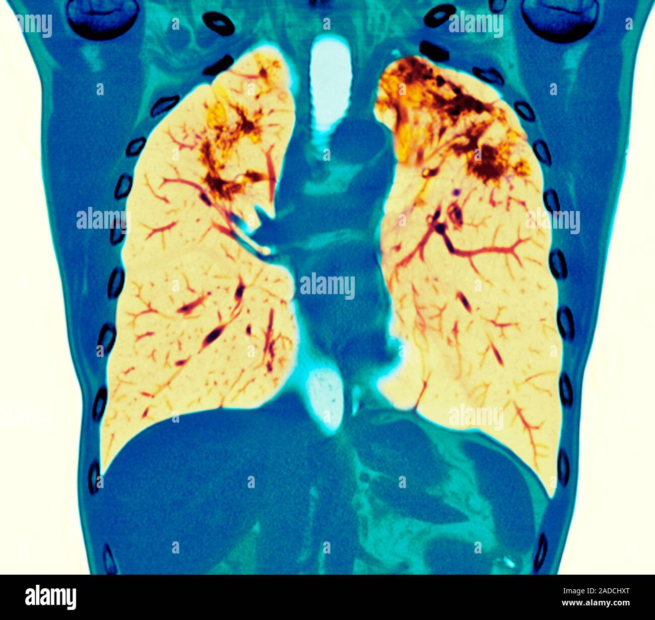 Pulmonary sarcoidosis. Computed tomography (CT) scan of a coronal ...