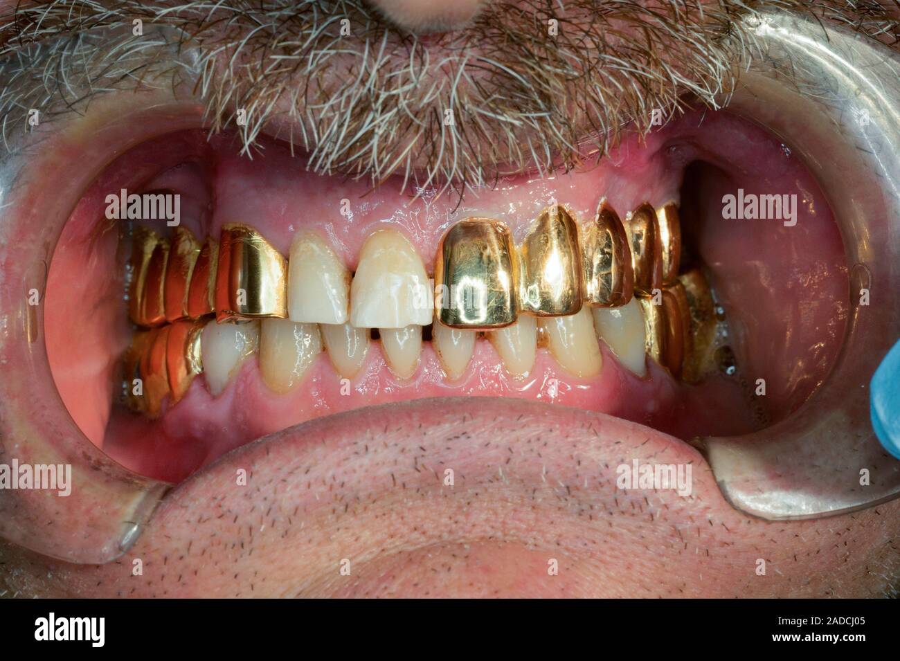 Close-up of the mouth of a patient with numerous gold crowns. Dental ...