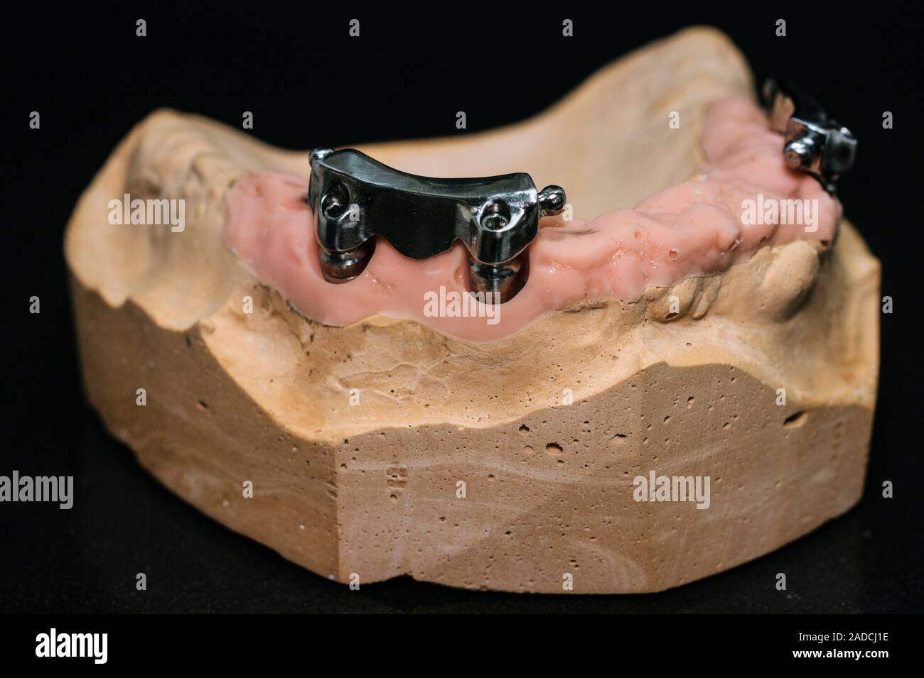 Dental cast with bar-retained denture. Plaster cast of a patient's ...