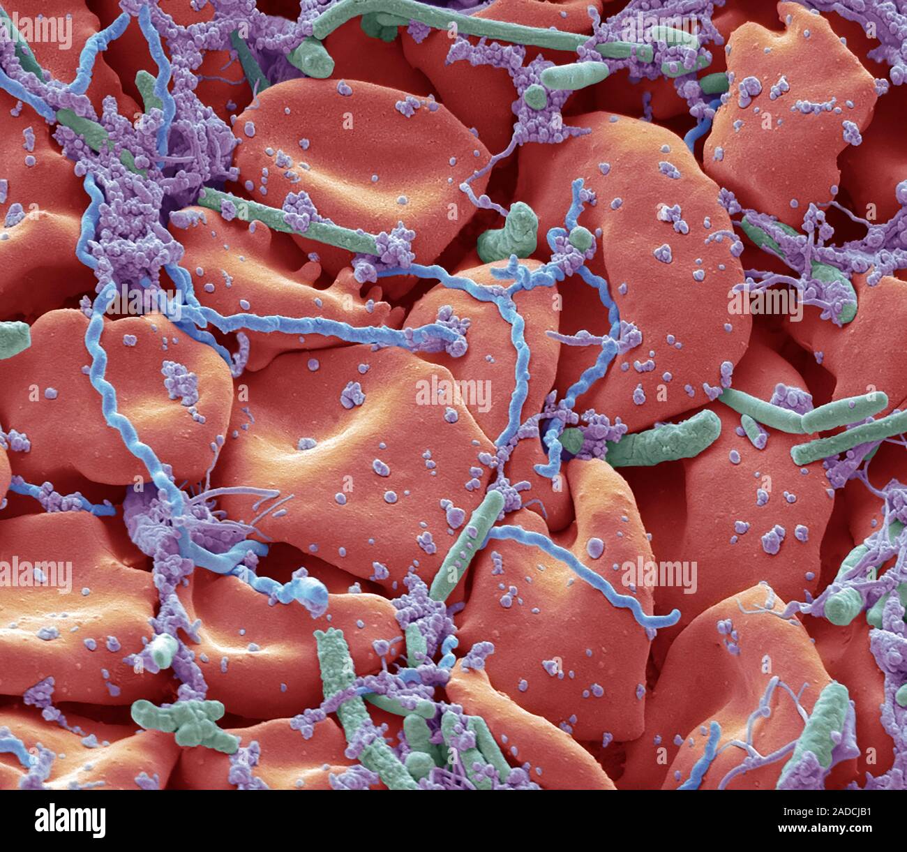 Bleeding gums. Scanning electron micrograph (SEM) of blood from ...