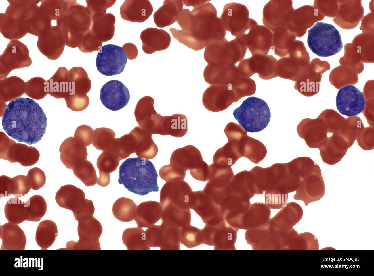 Acute monocytic leukaemia. Light micrograph of a blood smear from a ...