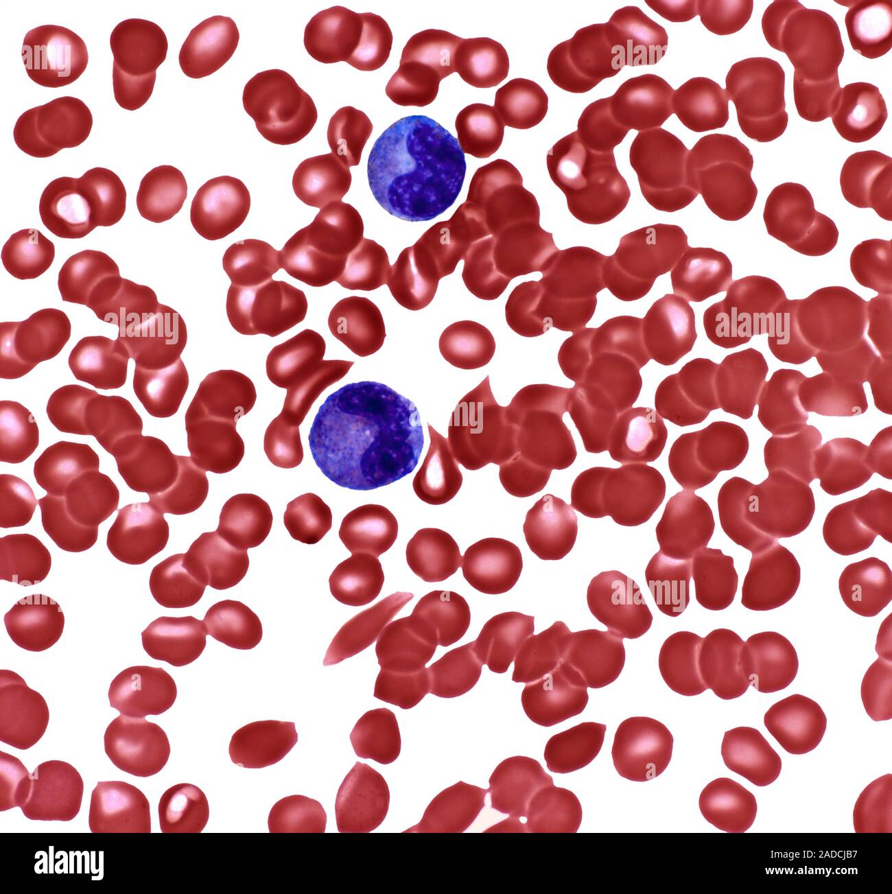 Iron deficiency anaemia. Light micrograph of a blood smear from a ...