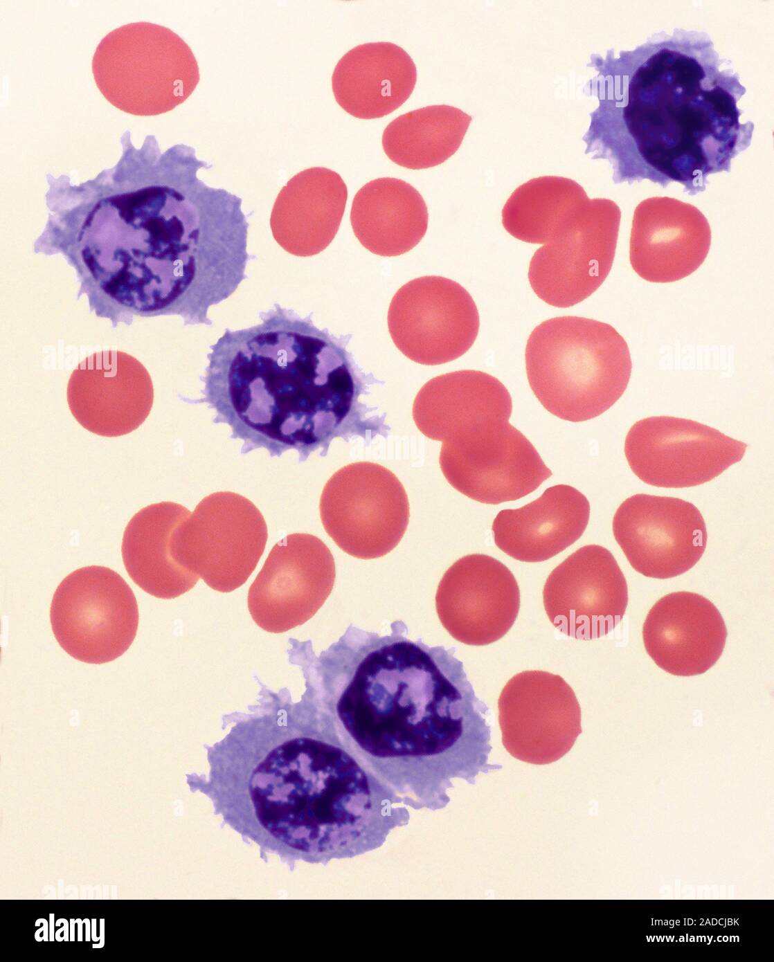 Hairy cell leukaemia. Light micrograph of a blood smear from a patient with hairy cell leukaemia ...