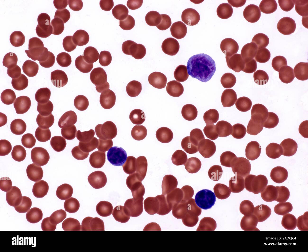 Polycythemia vera. Light micrograph of a blood smear from a patient ...