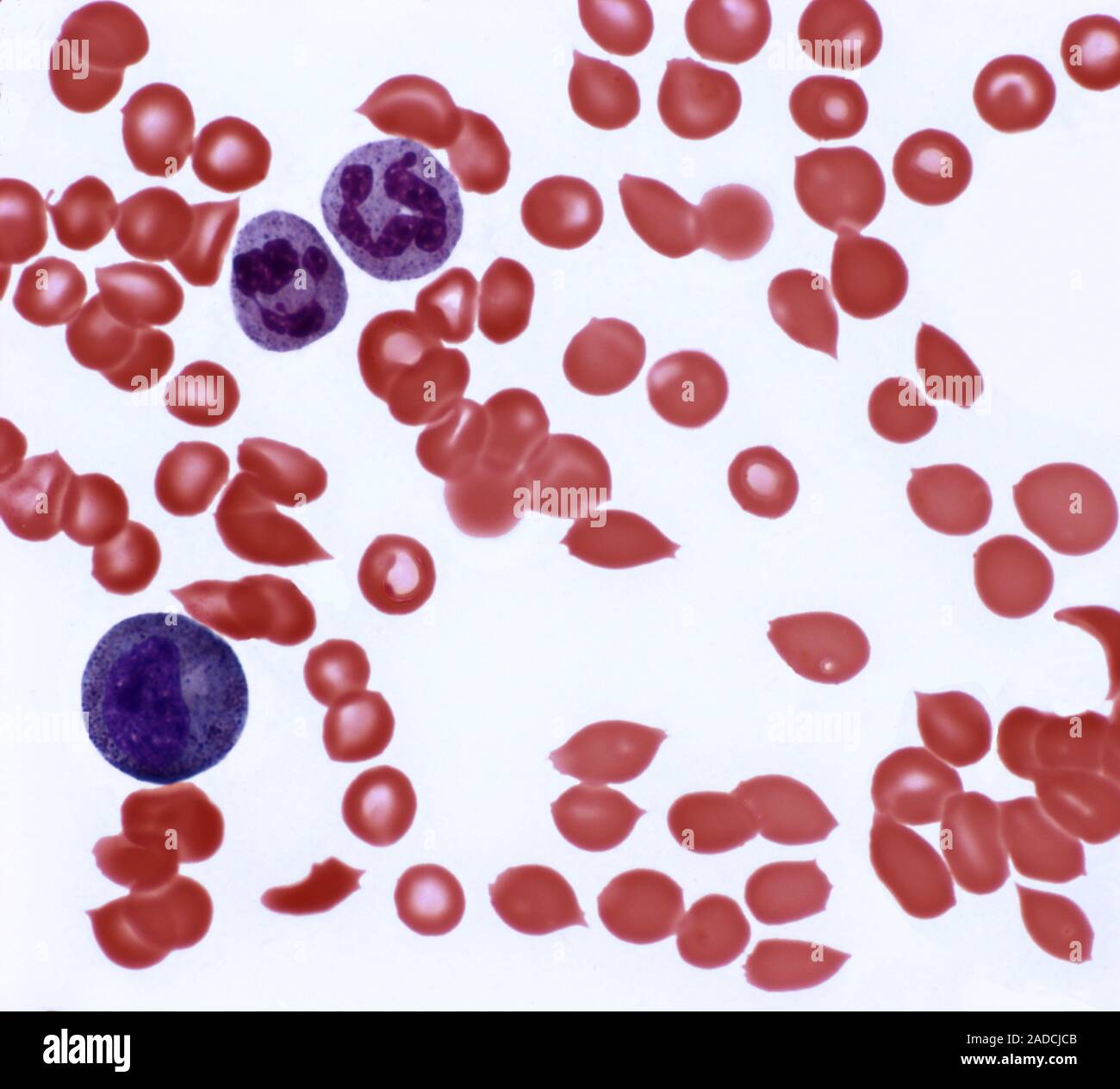 Iron deficiency anaemia. Light micrograph of a blood smear from a ...