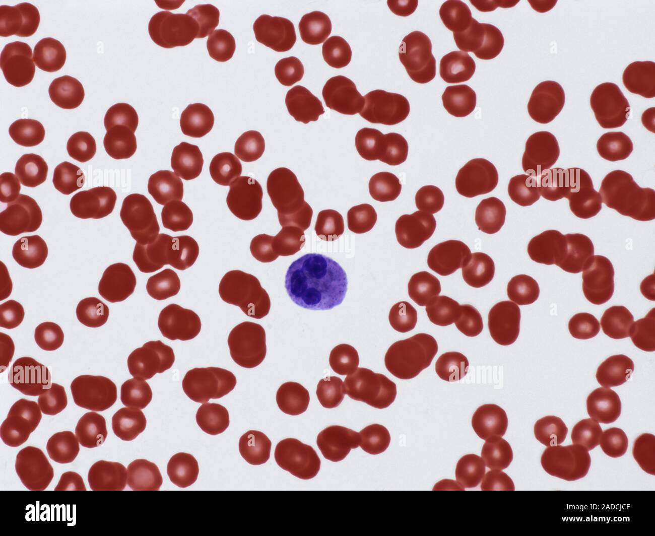 Light micrograph of a blood smear from a patient with leukopenia ...