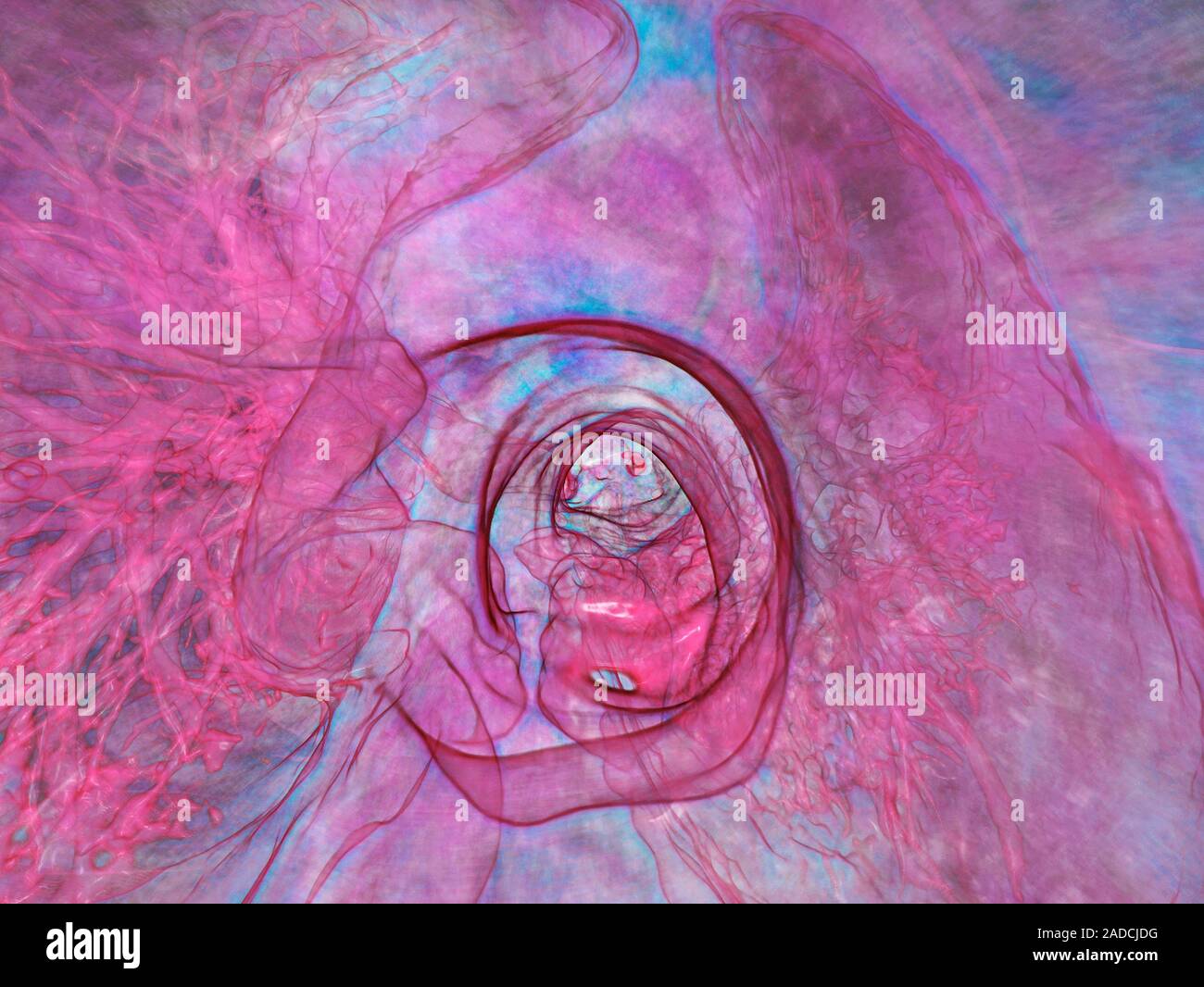 Bronchoscopy view. Coloured 3D computed tomography (CT) scan of the ...