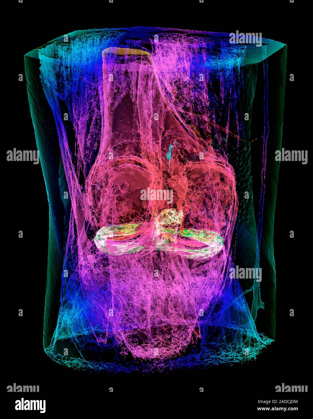 Knee menisci and ligaments. Coloured 3D magnetic resonance imaging (MRI ...