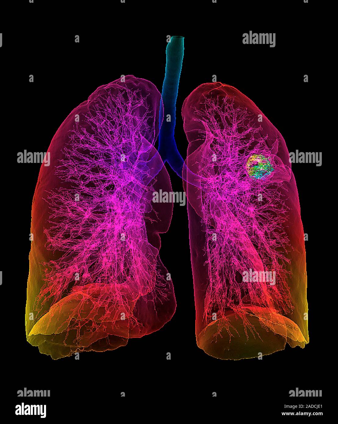 Lung cancer. Coloured 3D frontal computed tomography (CT) scan of human ... Lung cancer. Coloured 3D frontal computed tomography (CT) scan of human ...