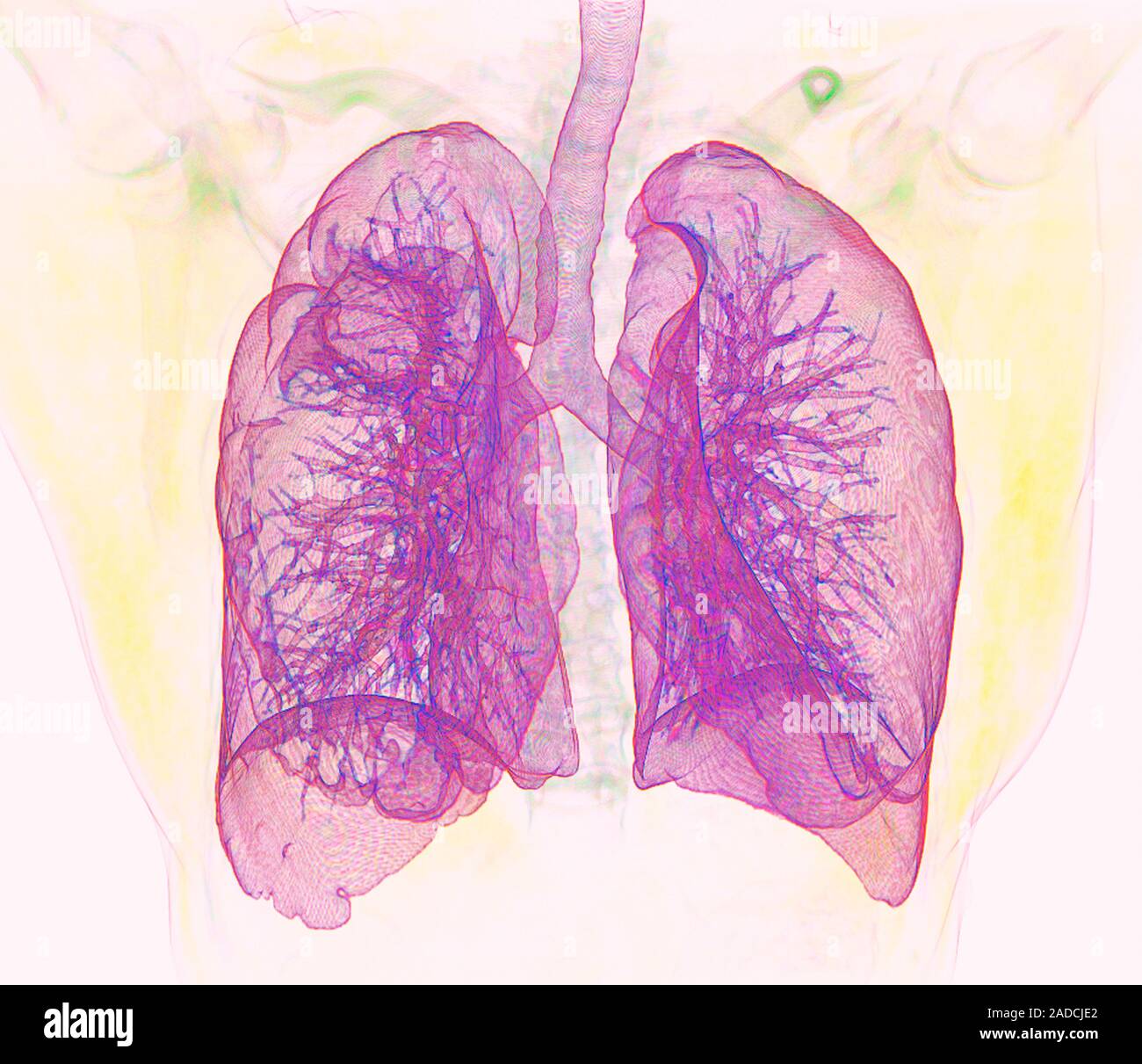 Lung cancer. Coloured 3D frontal computed tomography (CT) scan of human ... Lung cancer. Coloured 3D frontal computed tomography (CT) scan of human ...