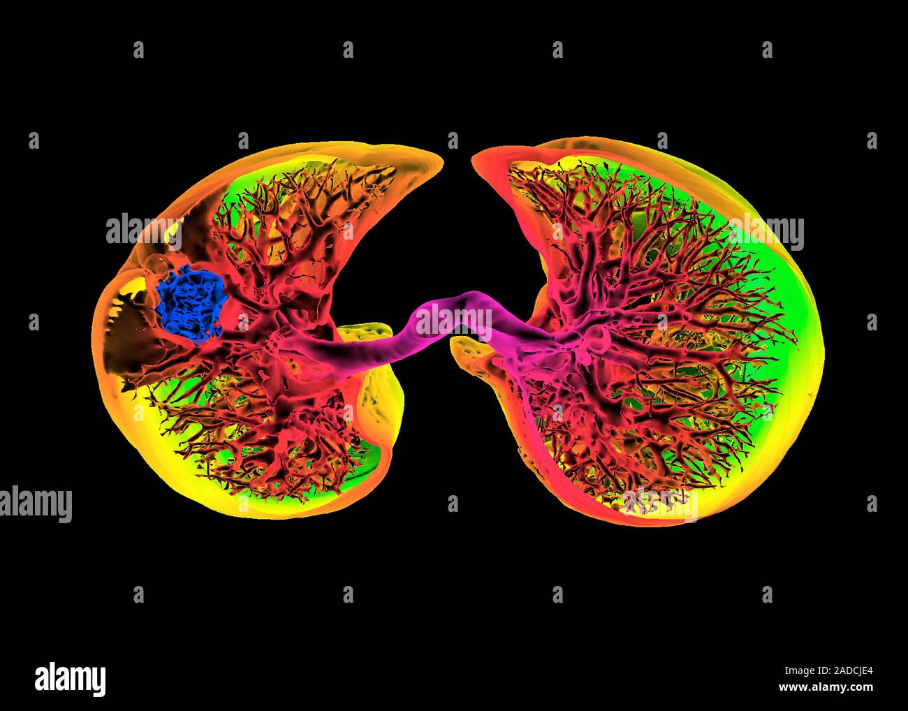 Lung cancer. Coloured 3D axial computed tomography (CT) scan of human ...