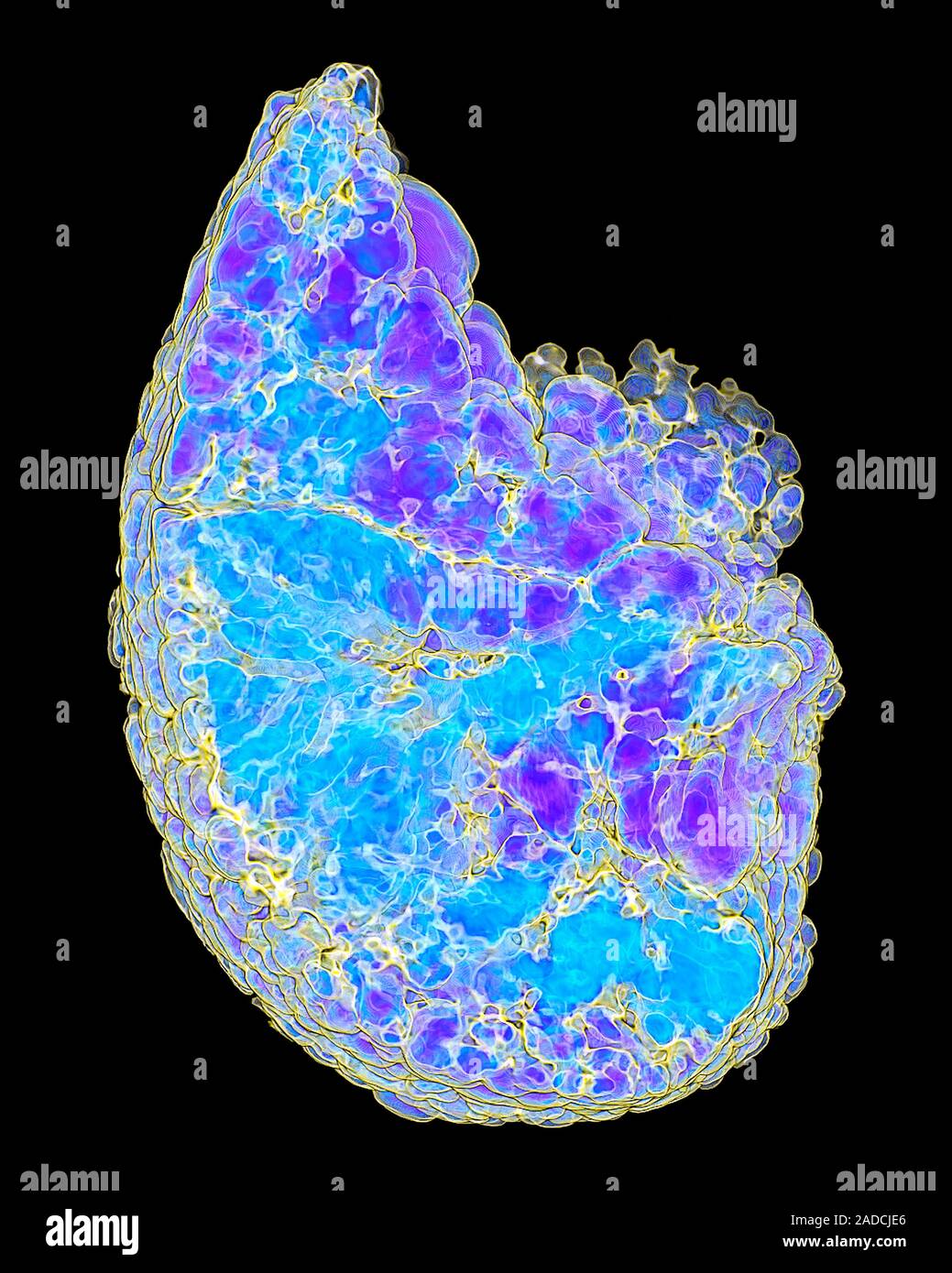 Smoker's lungs and emphysema. Axial section through a coloured 3D ...