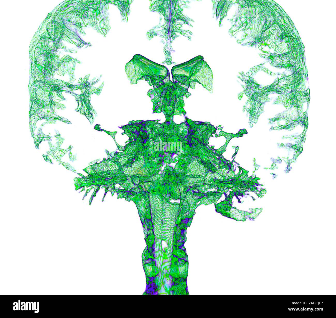 Brain cerebrospinal fluid spaces. Coloured 3D magnetic resonance ...