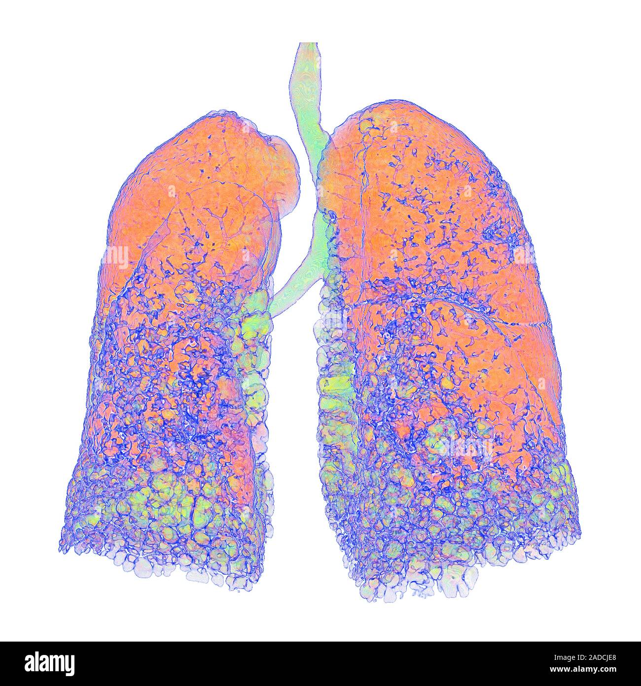 Usual interstitial pneumonia. Coloured 3D computed tomography (CT) scan ...