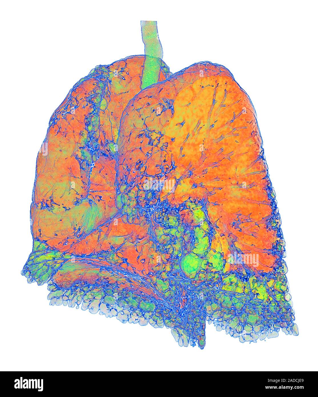 Usual interstitial pneumonia. Coloured 3D computed tomography (CT) scan ...