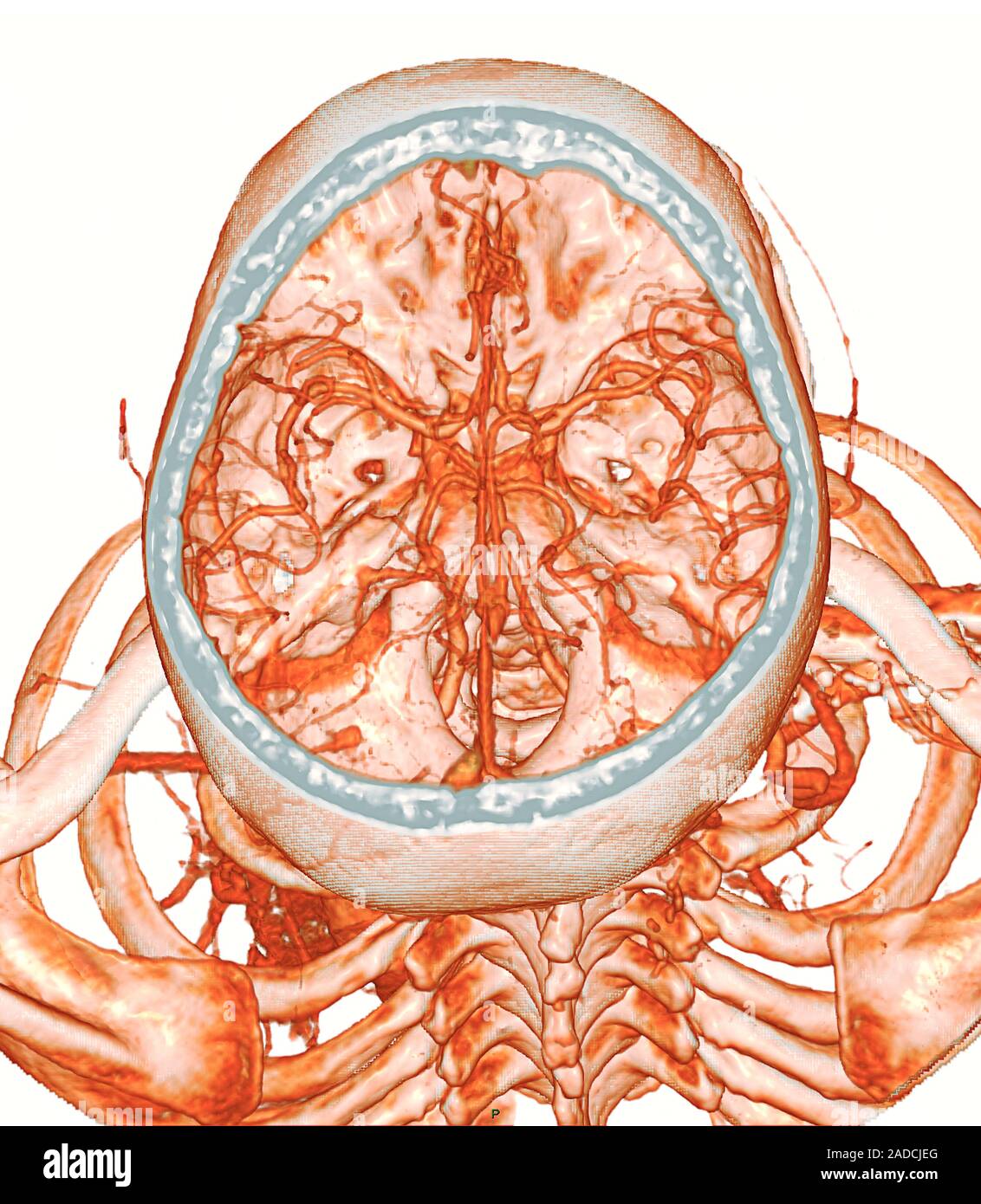 Intracranial blood vessels. Coloured 3D computed tomography (CT) angiogram of intracranial blood ...