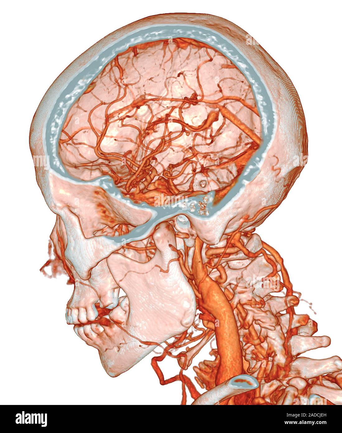 Intracranial and neck blood vessels. Coloured lateral 3D computed tomography (CT) angiogram of ...