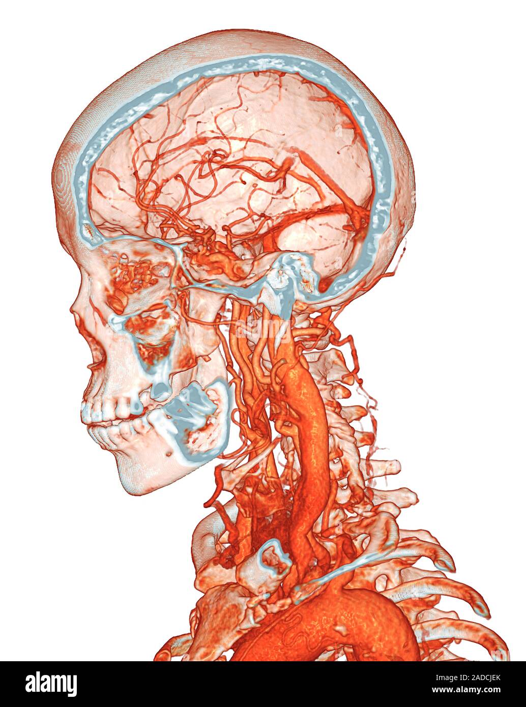 Intracranial and neck blood vessels. Coloured lateral 3D computed tomography (CT) angiogram of ...