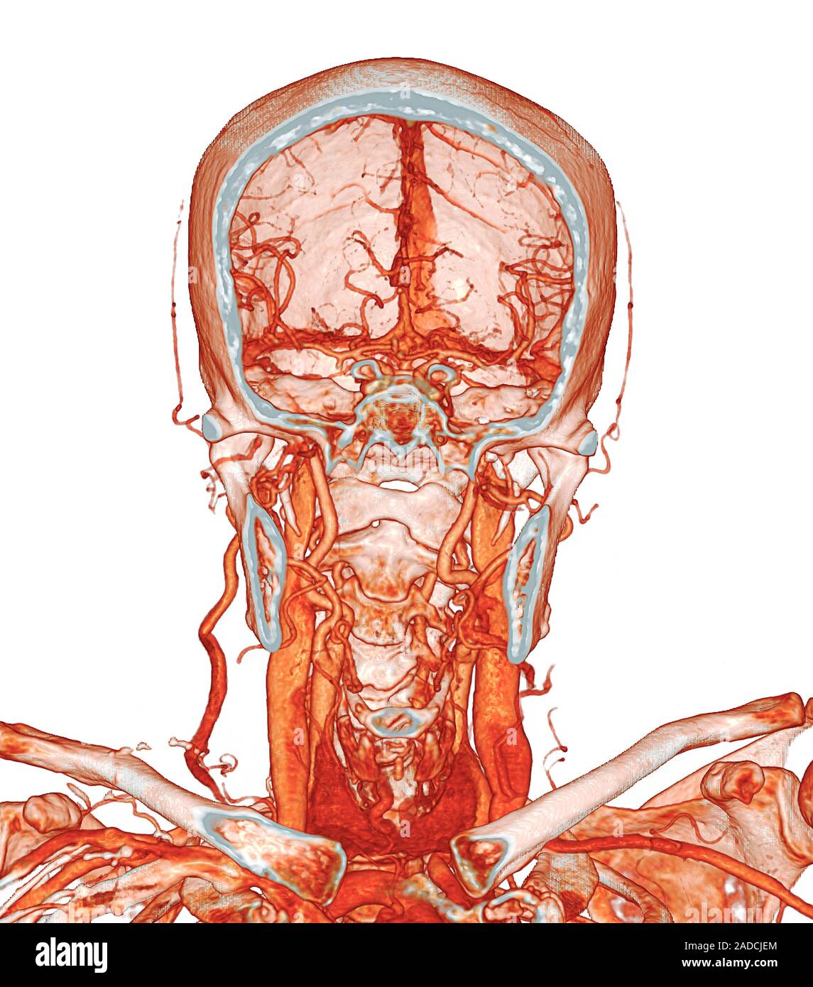 Intracranial and neck blood vessels. Coloured frontal 3D computed tomography (CT) angiogram of ...