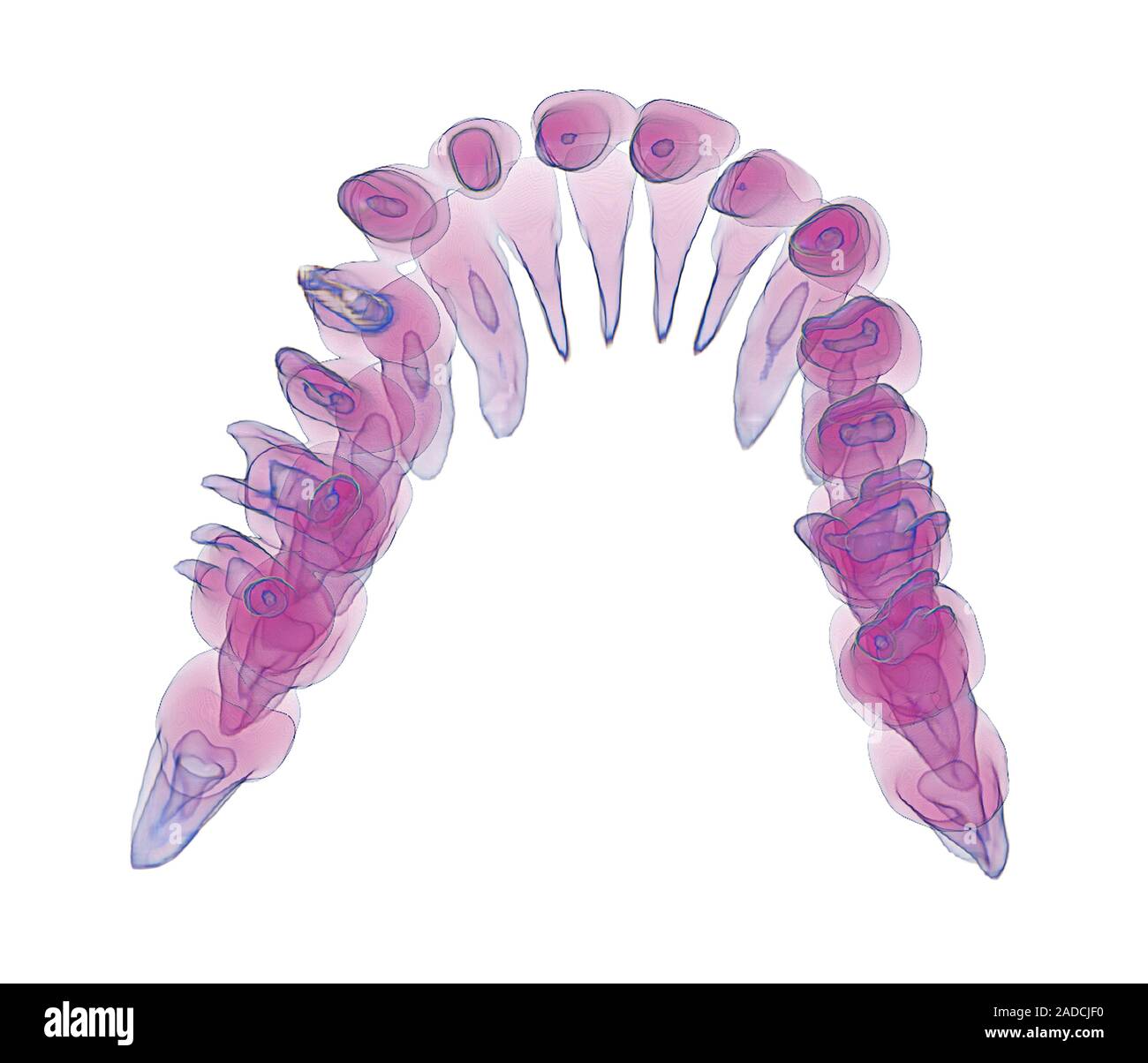 Human teeth. Coloured 3D computed tomography (CT) scan of the upper and ...