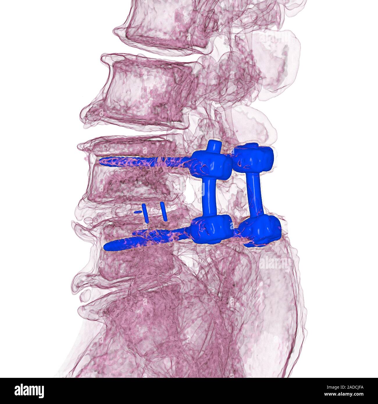 Spinal implant in lumbar fusion. Coloured lateral 3D computed ...