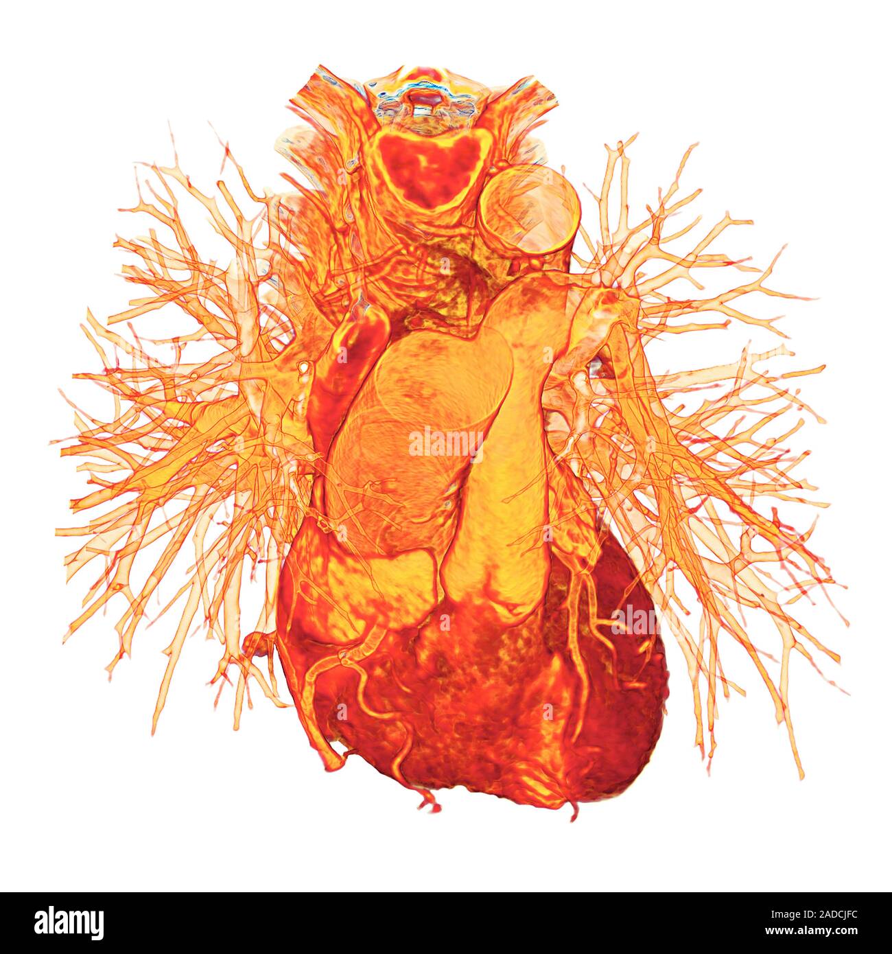 Human heart, 3D coloured frontal computed tomography (CT) angiogram ...
