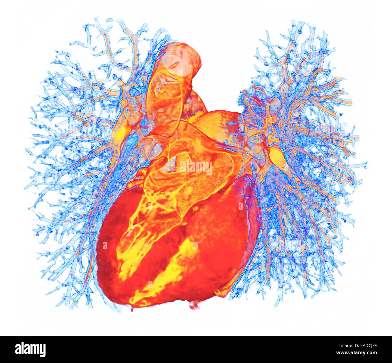 Human heart and lung bronchioles, 3D coloured computed tomography (CT ...