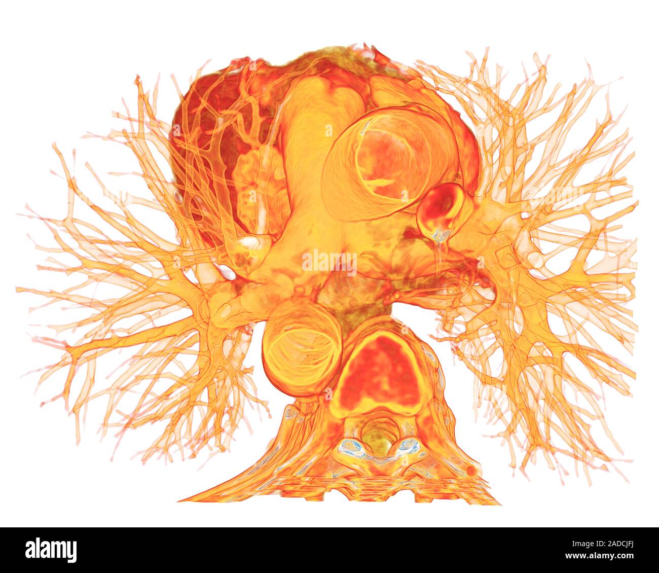 Human heart. 3D coloured computed tomography (CT) angiogram of the ...