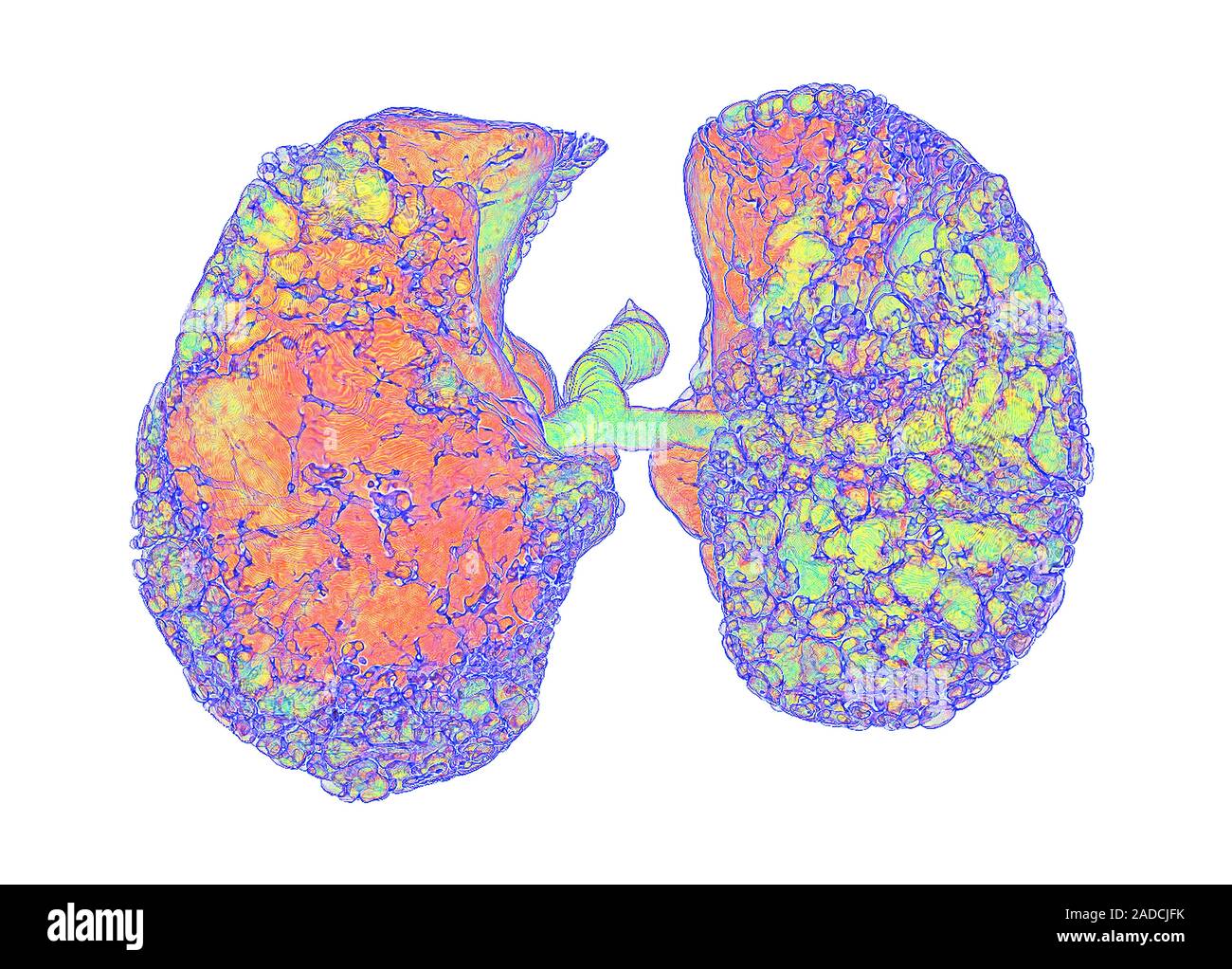 Usual interstitial pneumonia. Coloured axial 3D computed tomography (CT ...