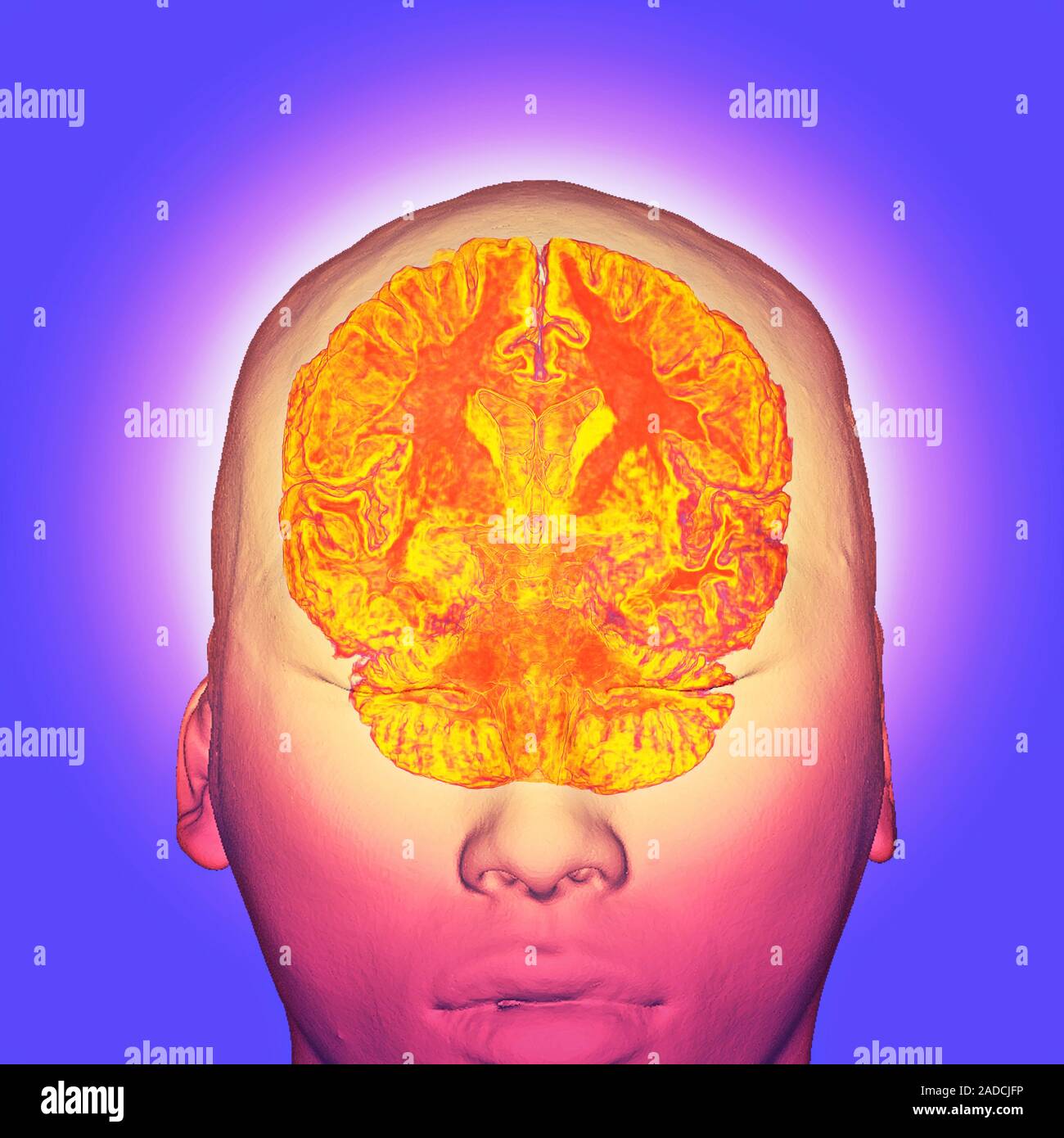 Human head and brain. Coloured 3D computed tomography (CT) and magnetic resonance imaging (MRI ...