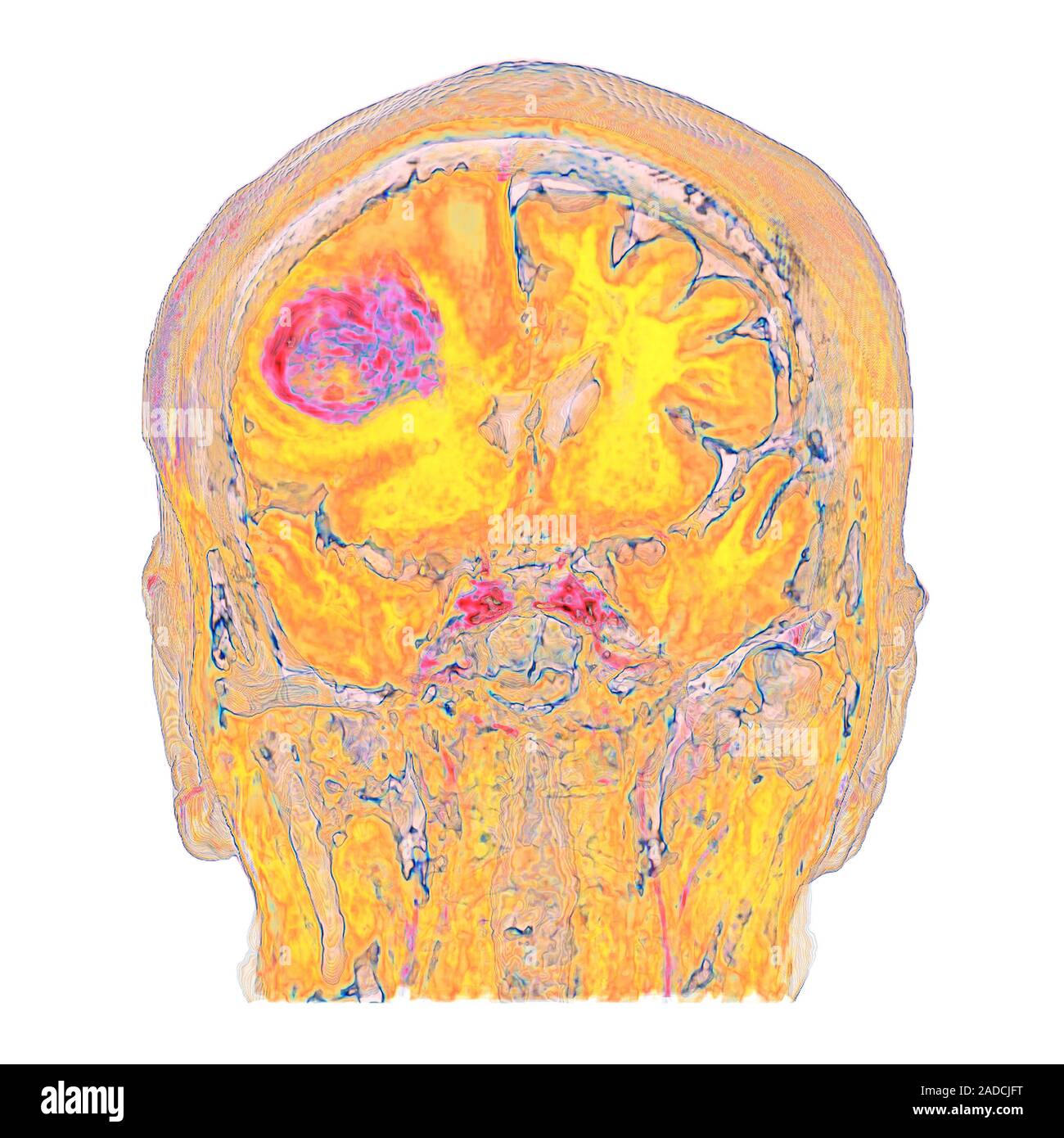 Metastatic brain cancer. Coloured coronal magnetic resonance imaging ...