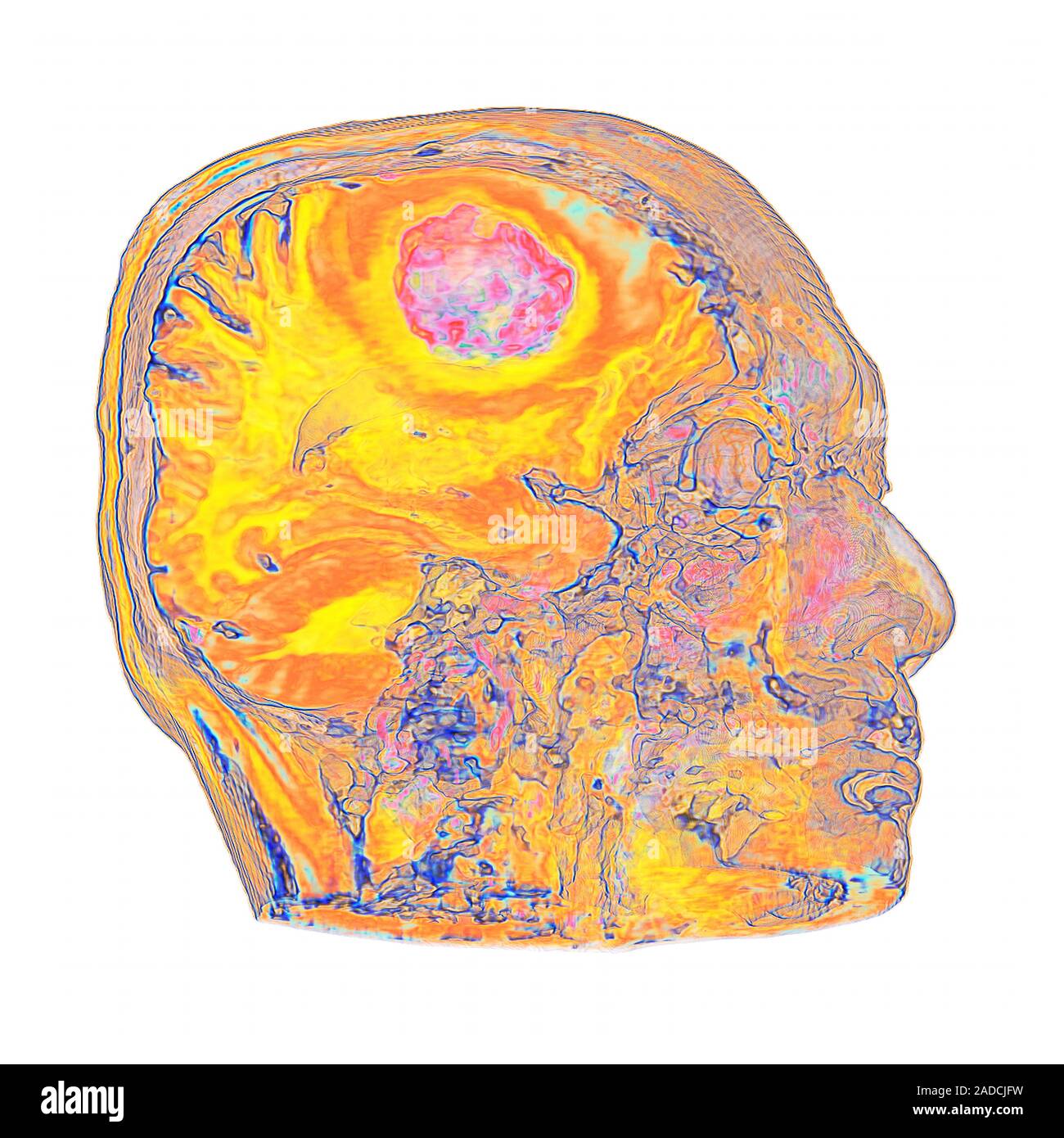 Metastatic brain cancer. Coloured sagittal magnetic resonance imaging (MRI) scan through the ...